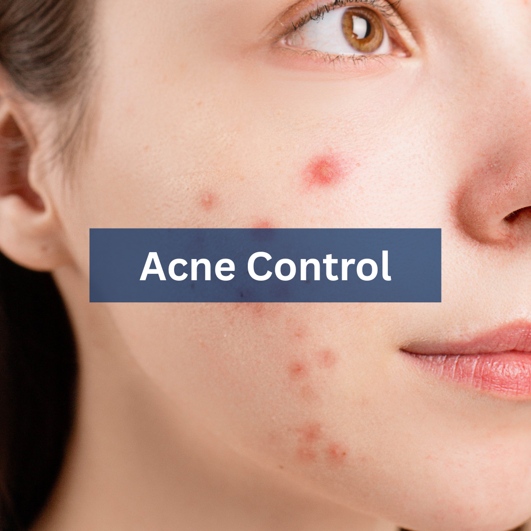 Acne Control Products | Effective Solutions for Clear Skin – LapinD'or